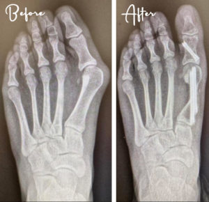 Minimally Invasive Bunion Surgery Thousand Oaks, CA